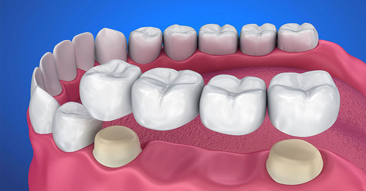 Dentures - Antoniou Dental Care